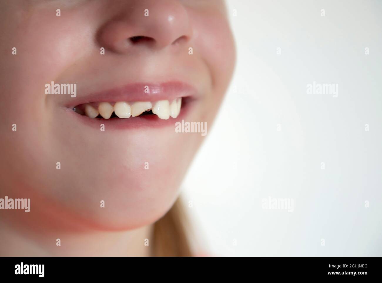Broken teeth hi-res stock photography and images - Alamy