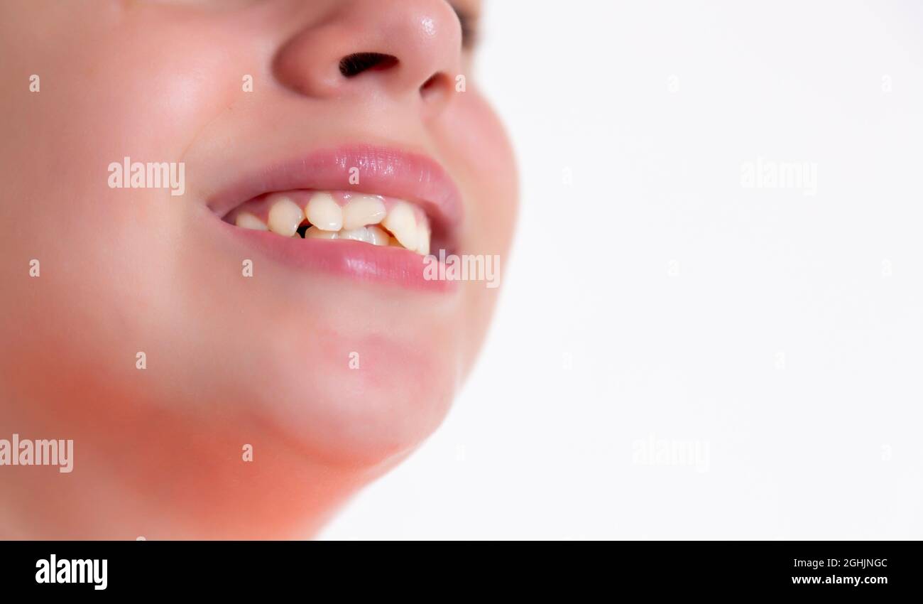 The girl knocked out two front teeth. Teeth augmentation Stock Photo ...