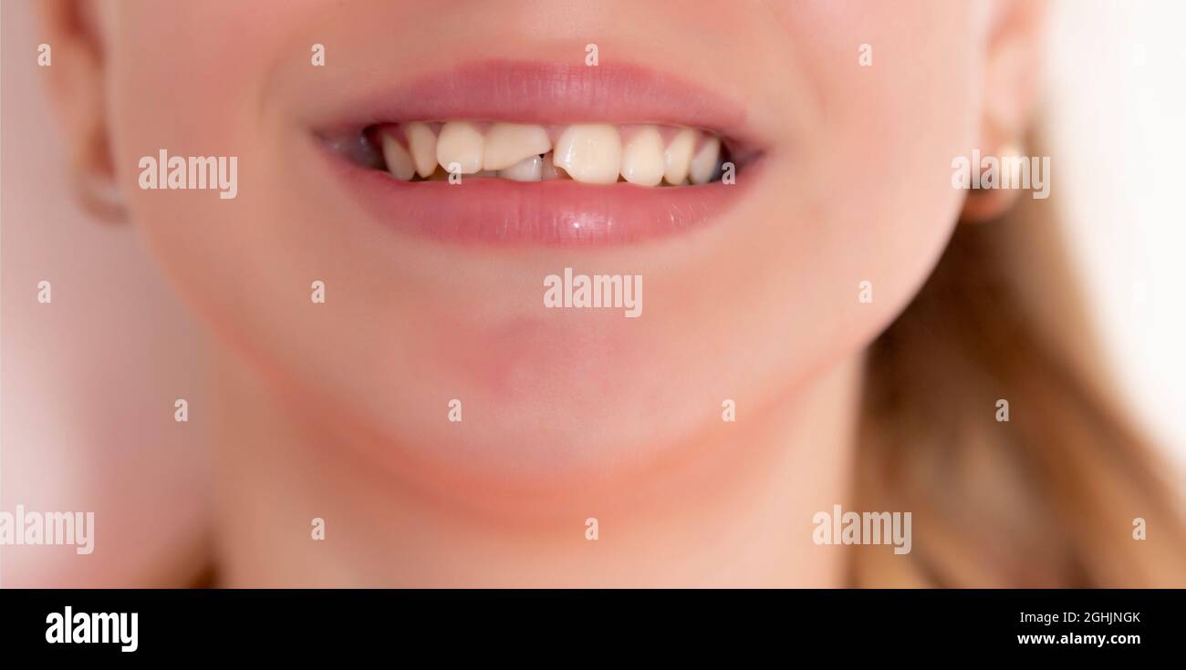 Broken teeth hi-res stock photography and images - Alamy
