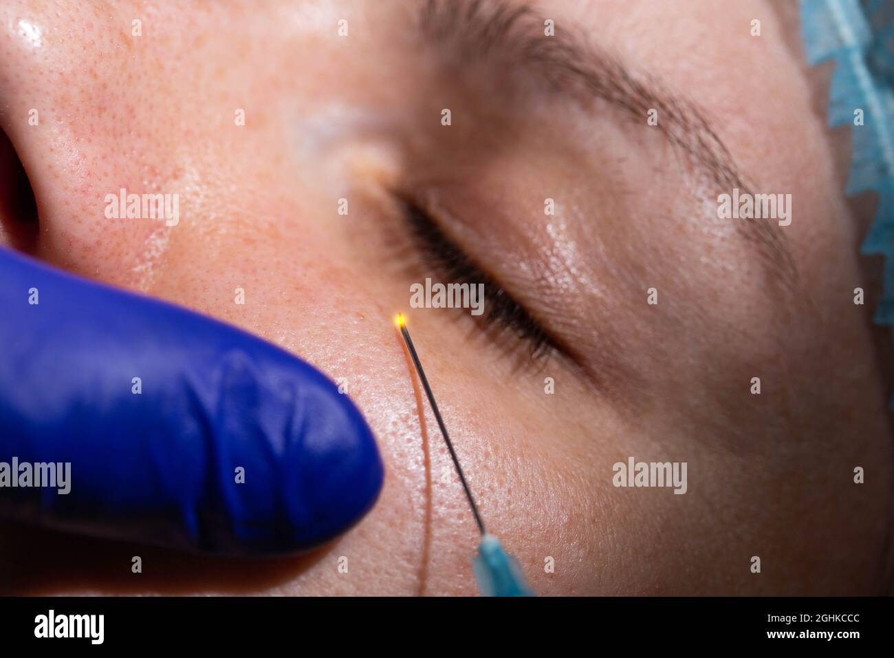 Doctor cosmetologist makes biorevitalization beauty injections into the ...