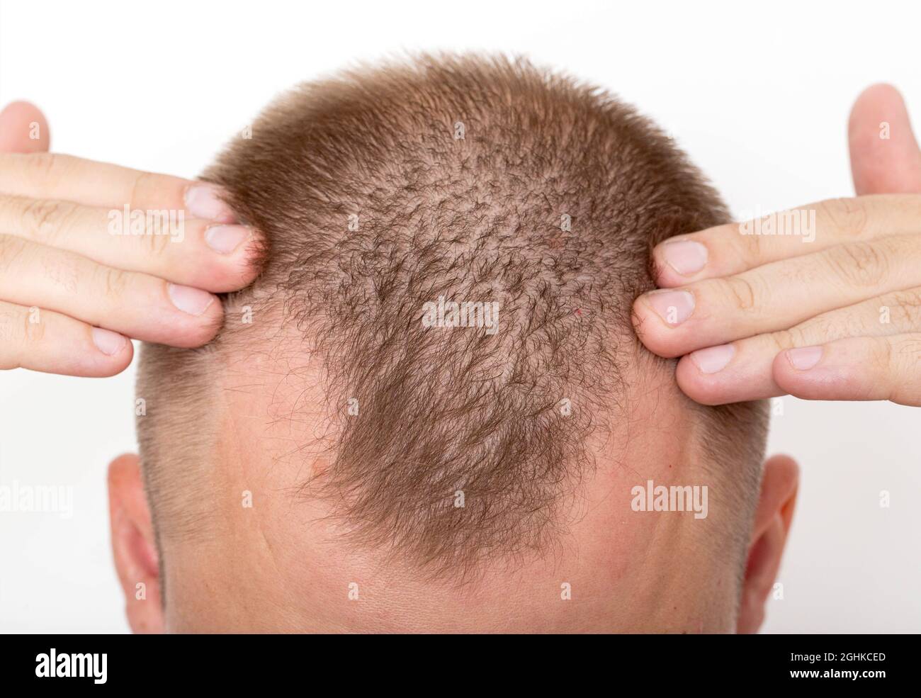 Frontal bald patches hi-res stock photography and images - Alamy