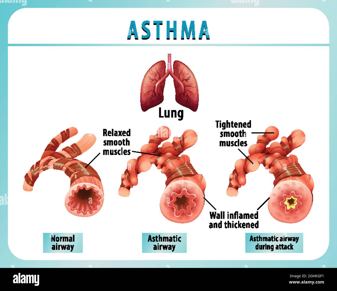 Bronchial Asthma diagram with normal airway and asthmatic airway ...
