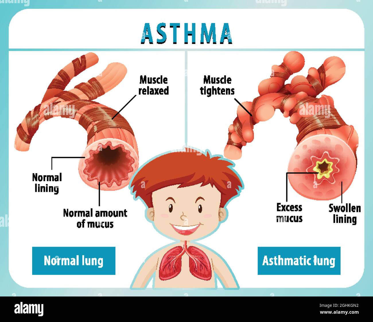 Asthma diagram with normal lung and asthmatic lung illustration Stock ...