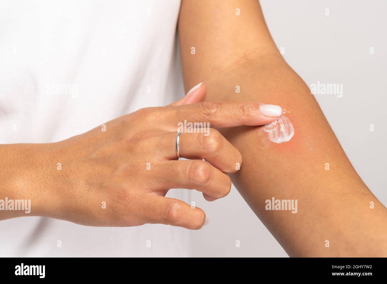 Female applying cream on swell skin after insect bites, isolated on ...