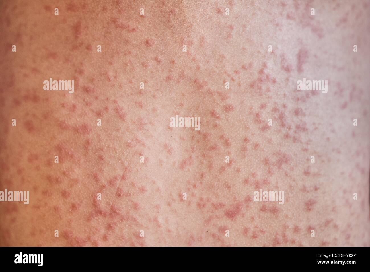 allergic rash on the body of the patient. 5 year old girl Stock Photo ...