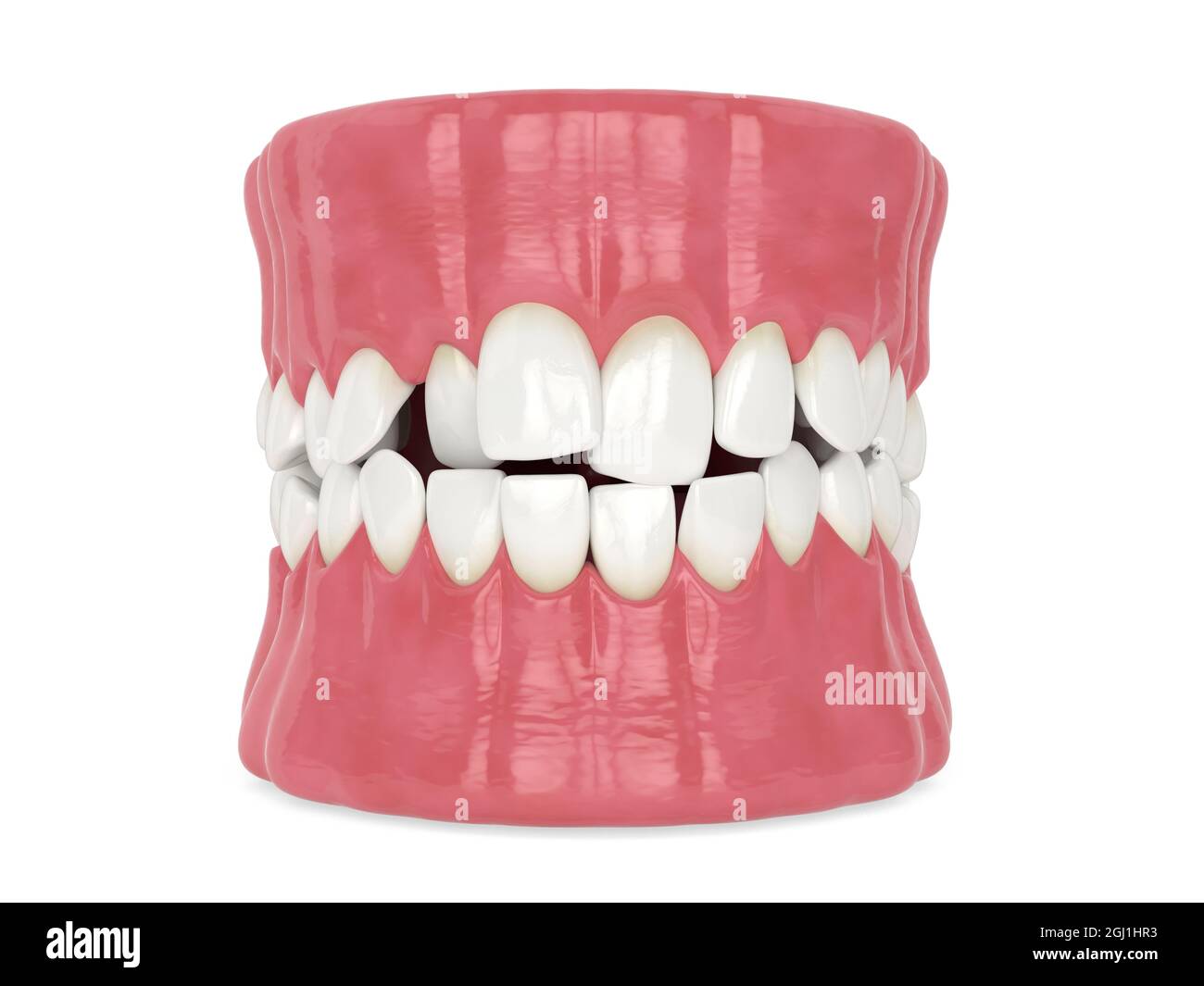 Overcrowded teeth abnormal dental hi-res stock photography and images ...