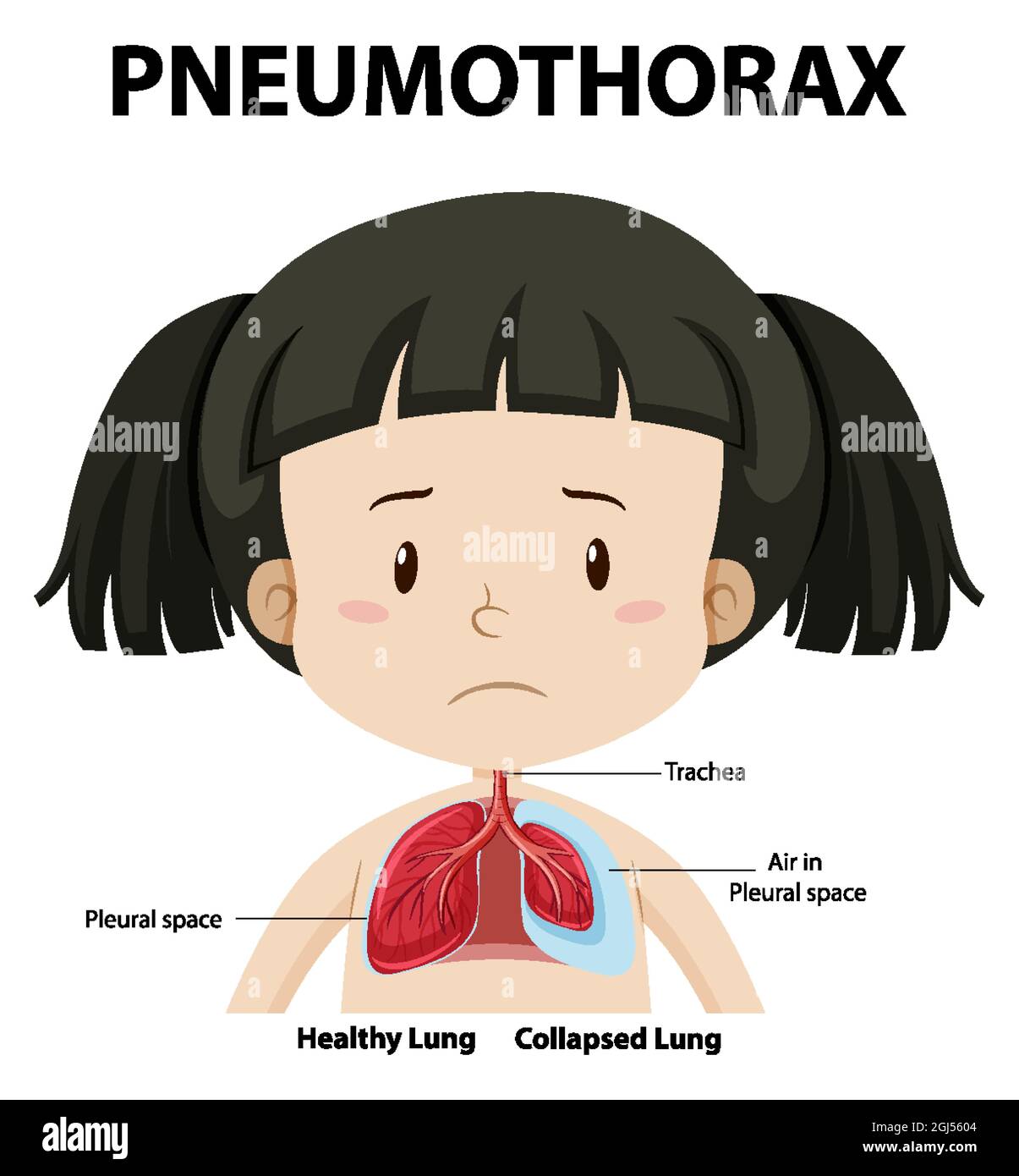 Pneumothorax diagram of human anatomy illustration Stock Vector Image ...