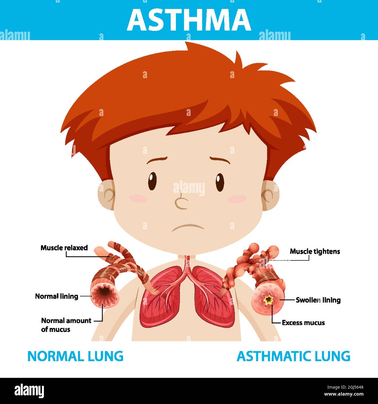 Asthma diagram with normal lung and asthmatic lung illustration Stock ...
