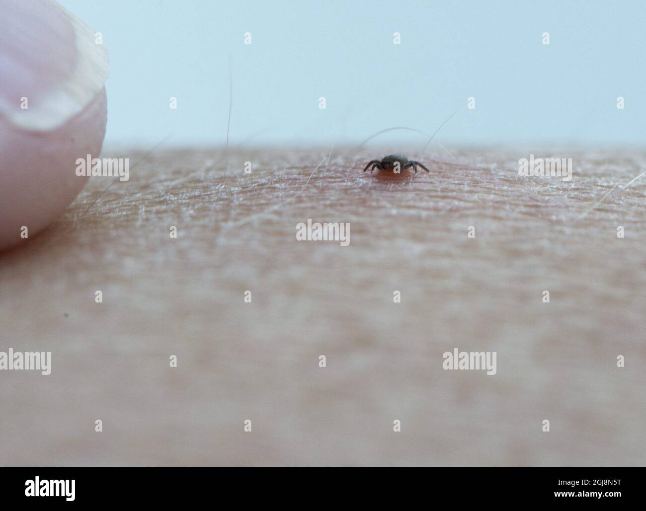 STOCKHOLM 20140819 A tick on human skin. Ticks are spreaders of ...