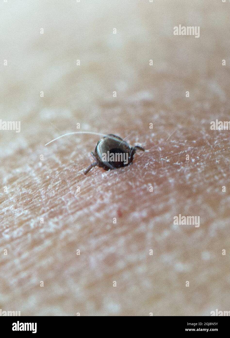 Tick borne encephalitis hi-res stock photography and images - Alamy