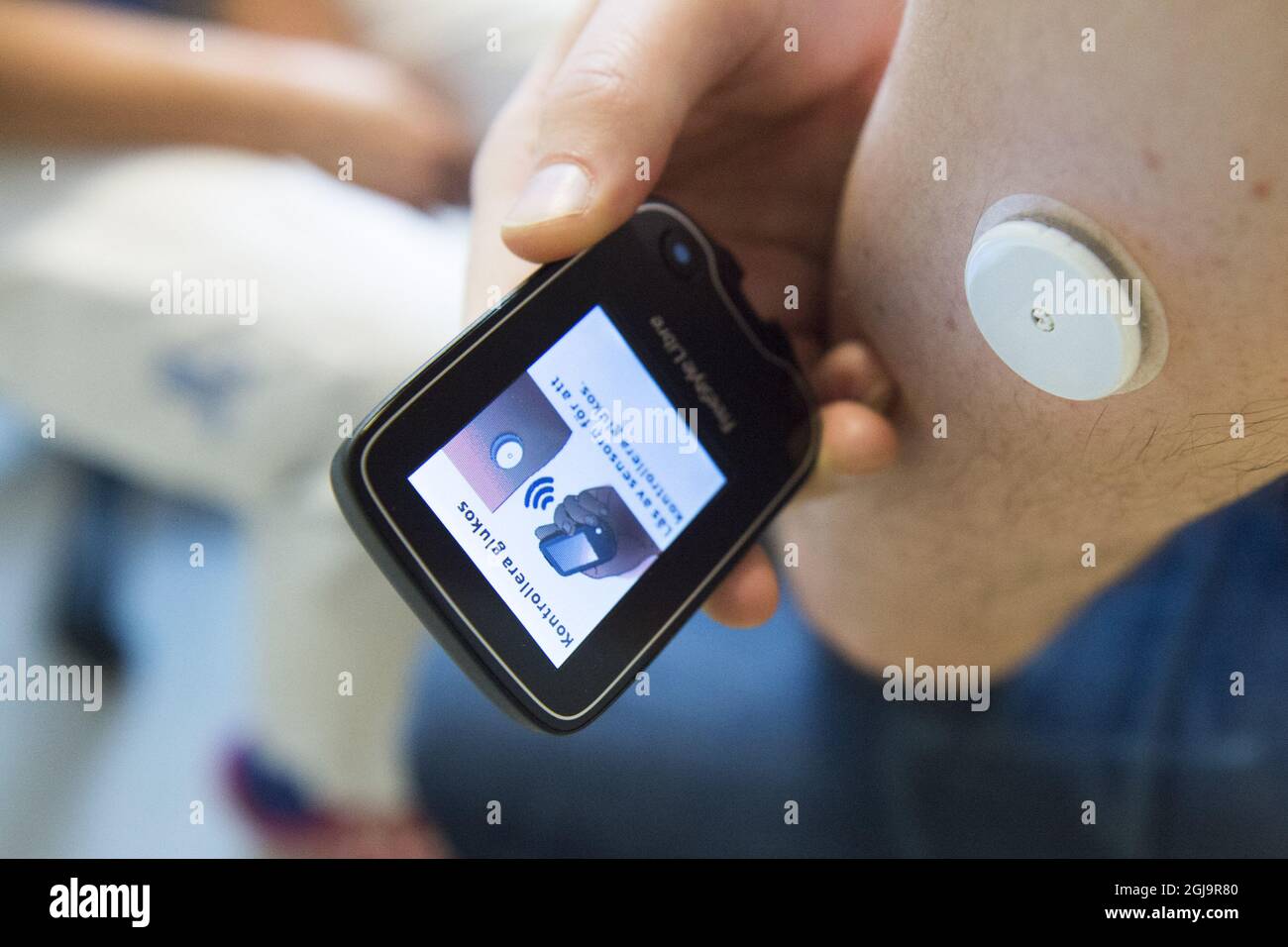 STOCKHOLM 2016-03-08 A patient with diabetes undergoes an operation to ...