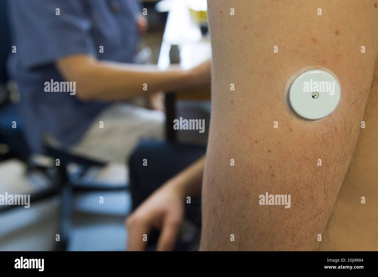 STOCKHOLM 2016-03-08 A patient with diabetes undergoes an operation to ...