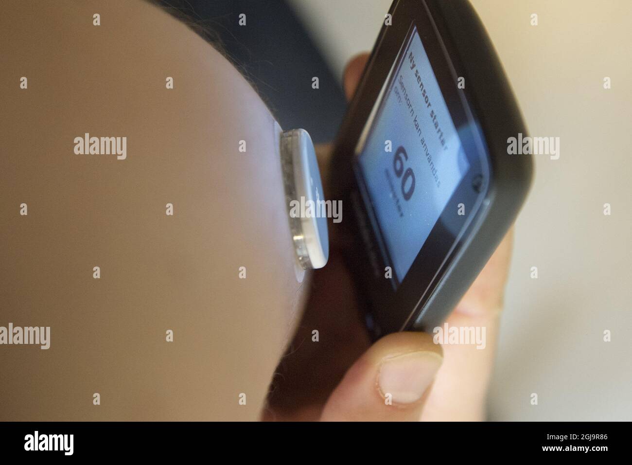 STOCKHOLM 2016-03-08 A patient with diabetes undergoes an operation to ...