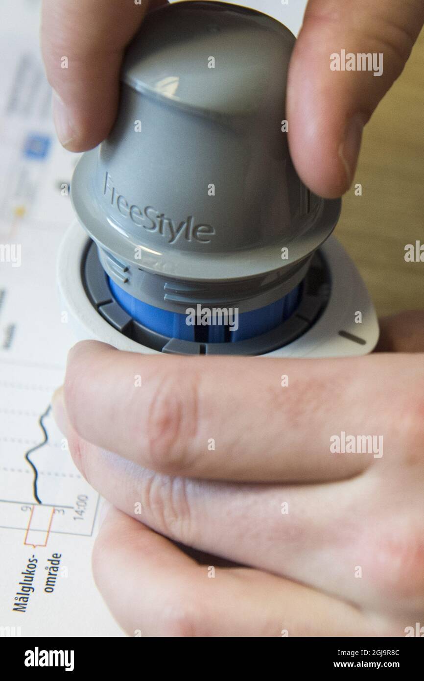 STOCKHOLM 2016-03-08 A patient with diabetes undergoes an operation to ...