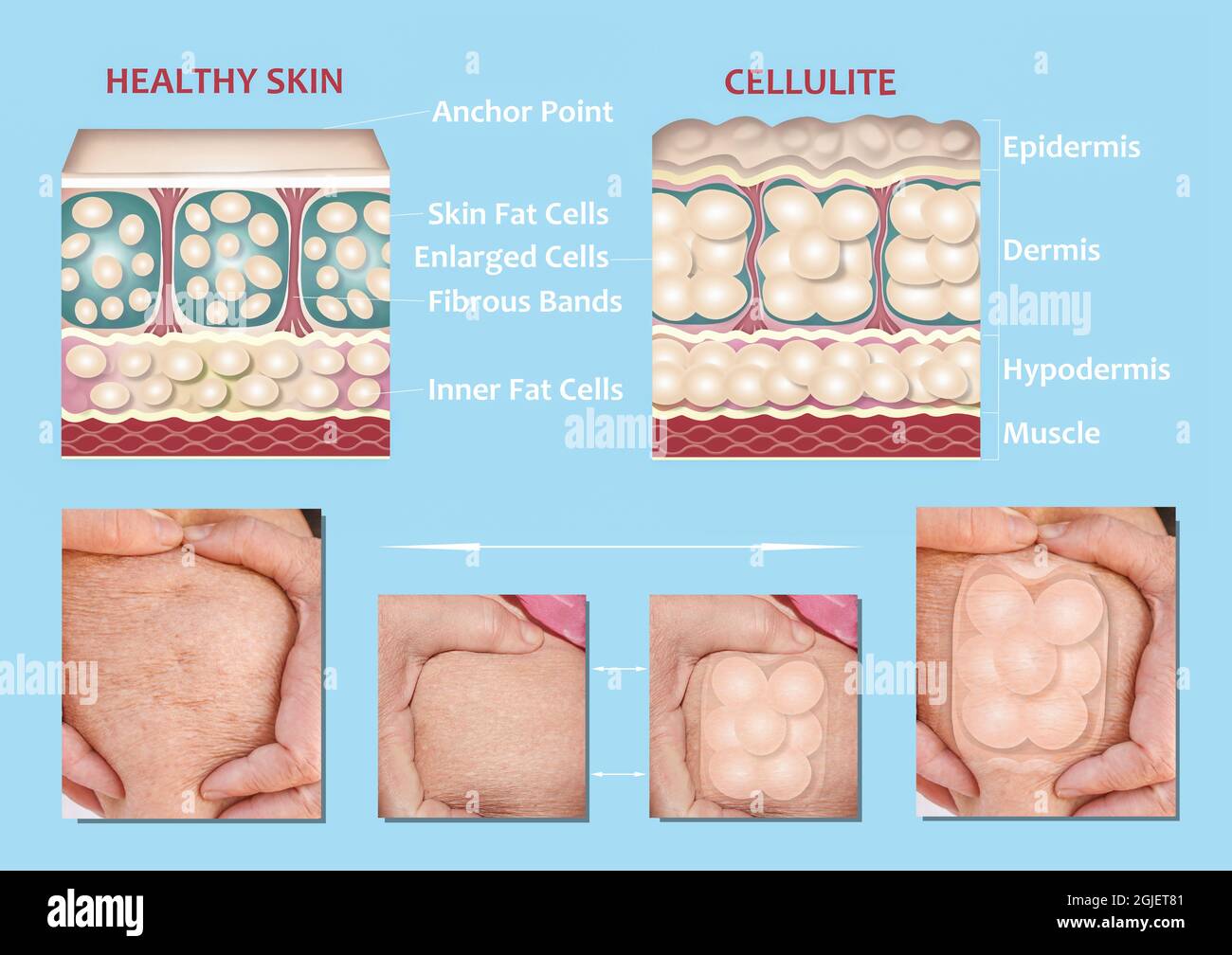 Forming of underskin cellulite illustration. Structure of normal ...