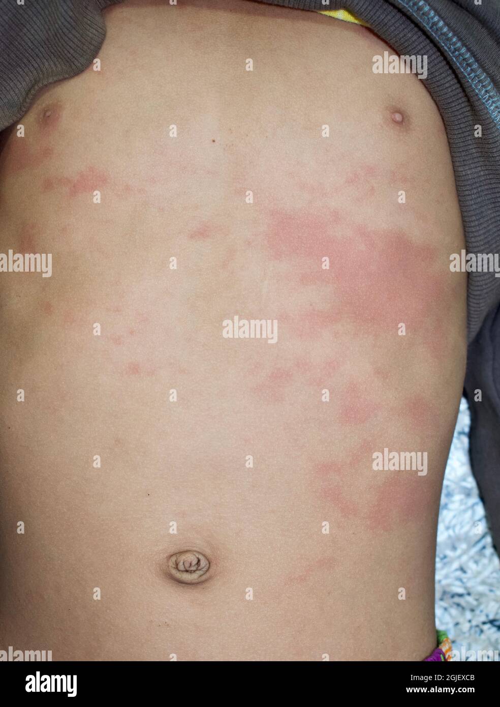 Rash over trunk of Asian young man. Widespread macular skin lesions ...