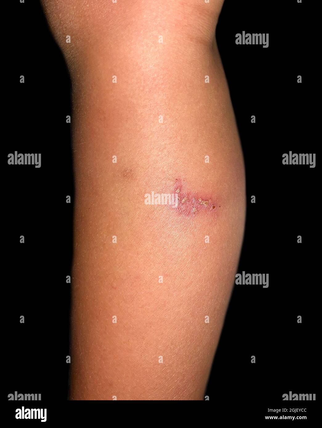 Pustules hi-res stock photography and images - Alamy