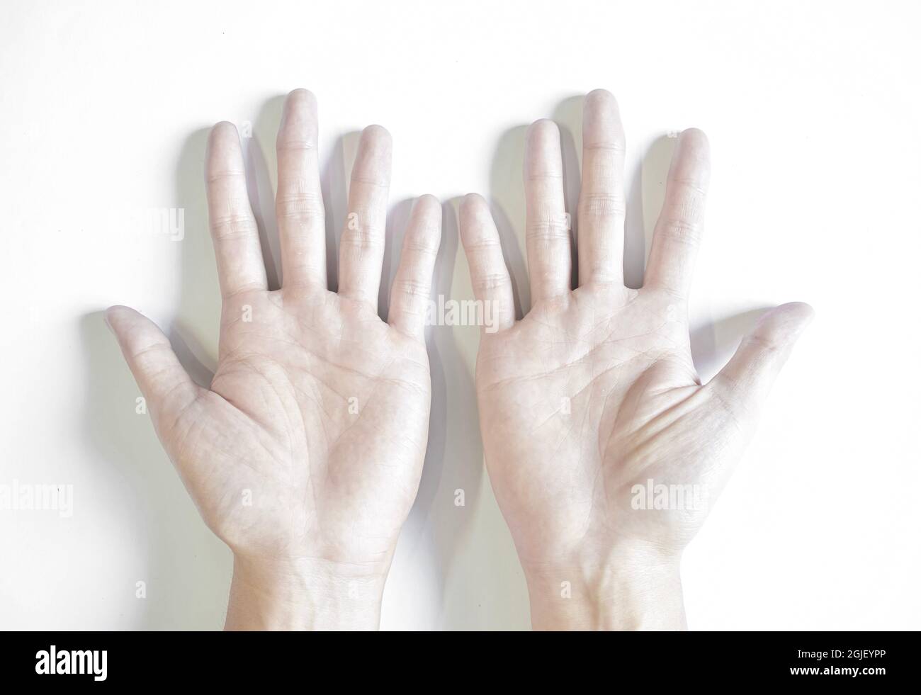 Pale palmar surface of both hands. Anaemic hands of Asian, Chinese man ...