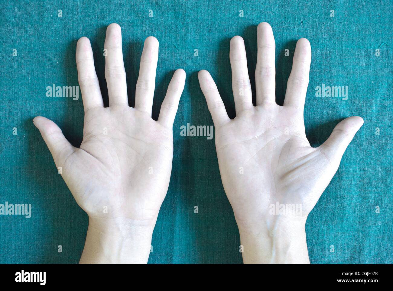 Anemic pallor hi-res stock photography and images - Alamy