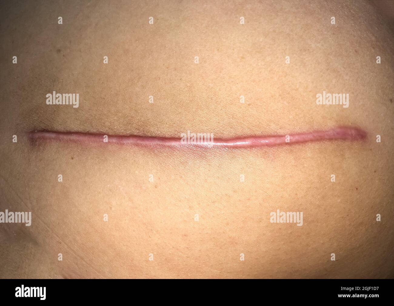 Abdominal incision hi-res stock photography and images - Alamy