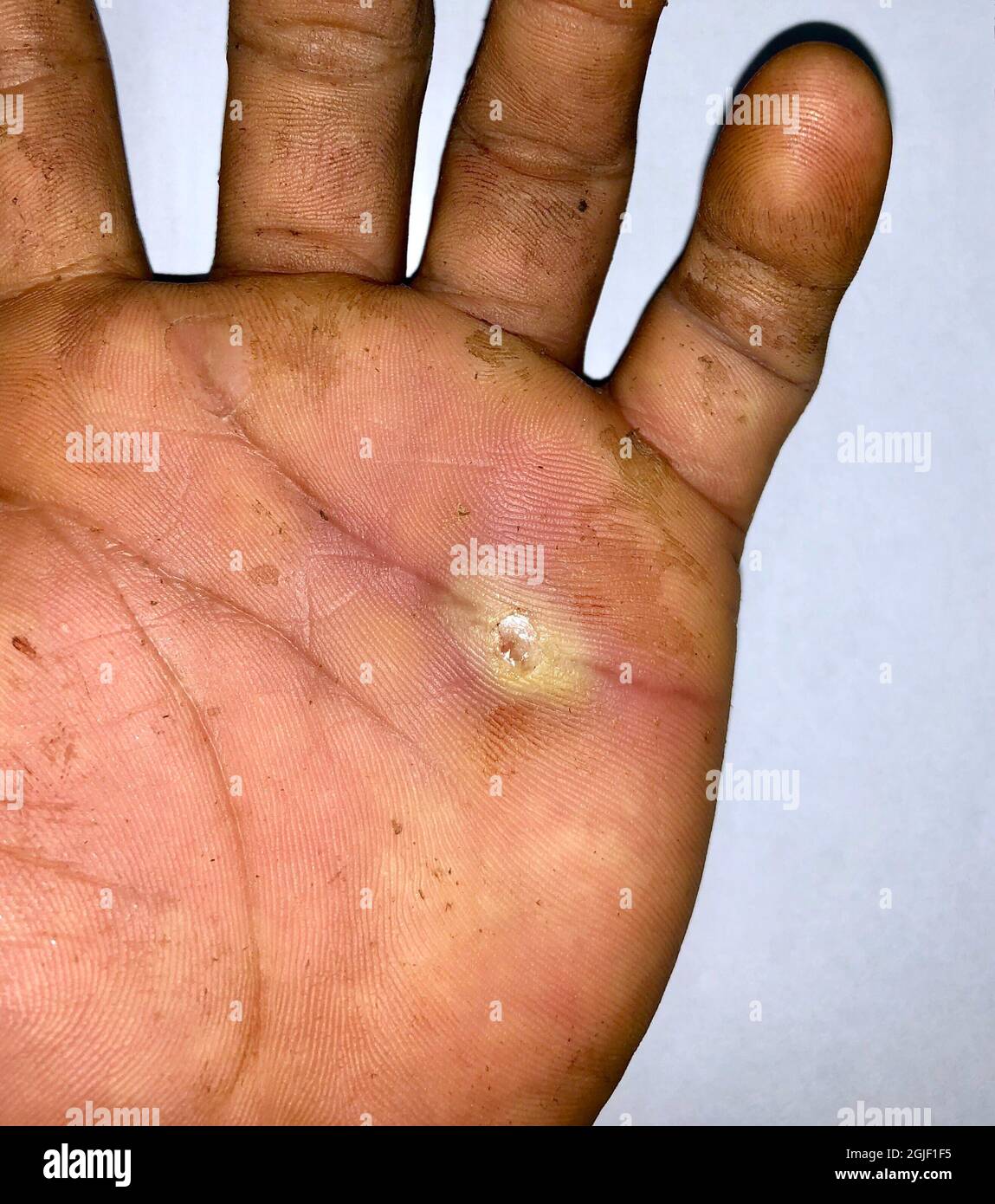 Cellulitis Hand Child