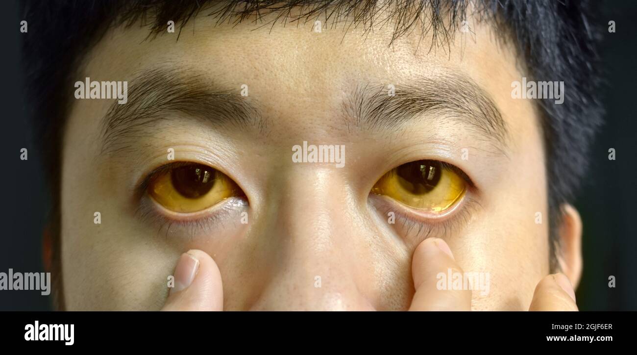 Person With Jaundice