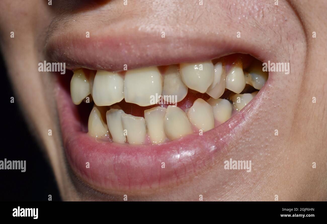 People With Extra Teeth