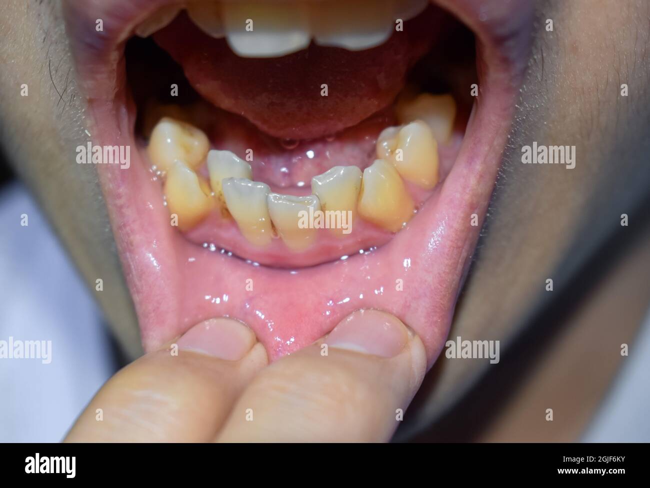 Stacked or overlapping teeth of Asian man. Also called crowded teeth ...