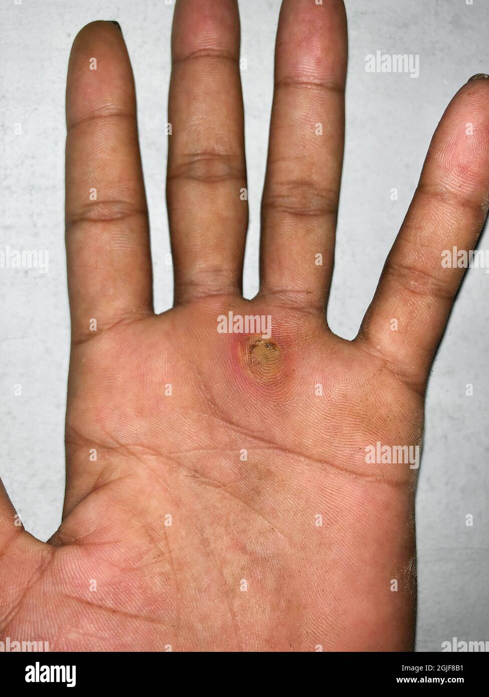 Strep Vs Staph Cellulitis