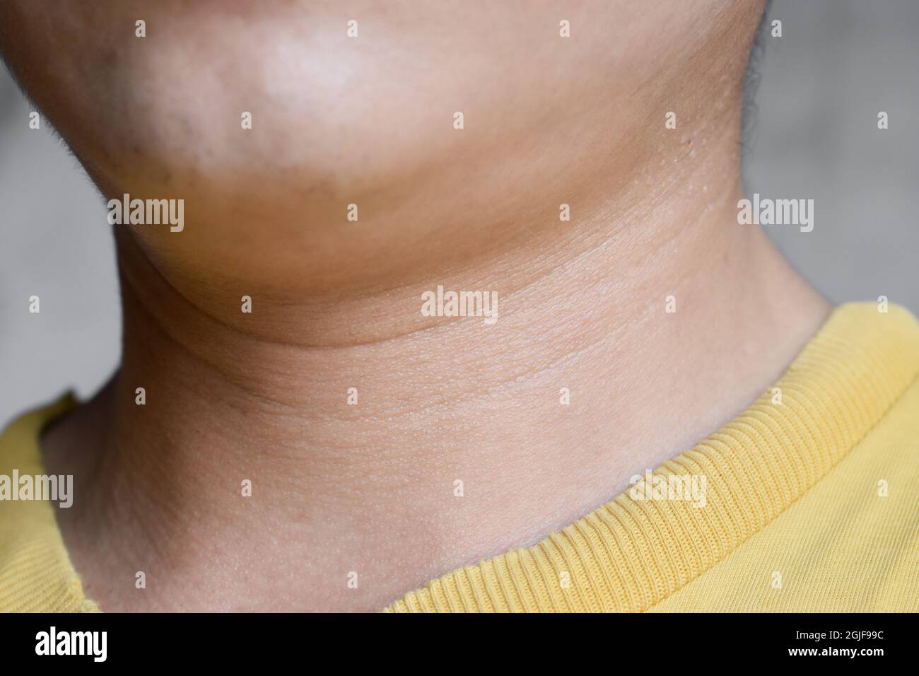 Aging skin folds or skin creases or wrinkles at neck of Southeast Asian ...