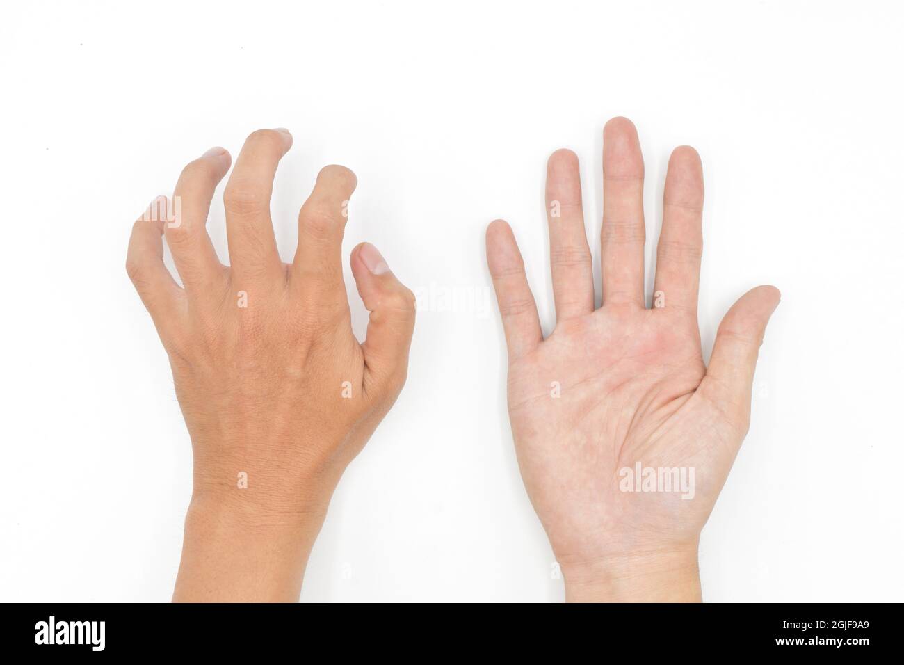 Hand muscle spasm in Asian young man. Unilateral fingers flexion ...