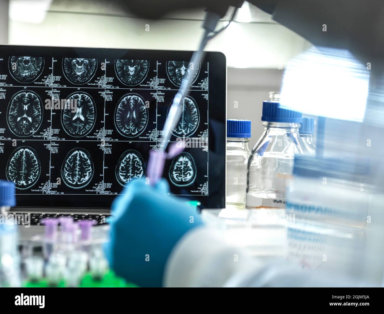 Alzheimers brain scan hi-res stock photography and images - Alamy