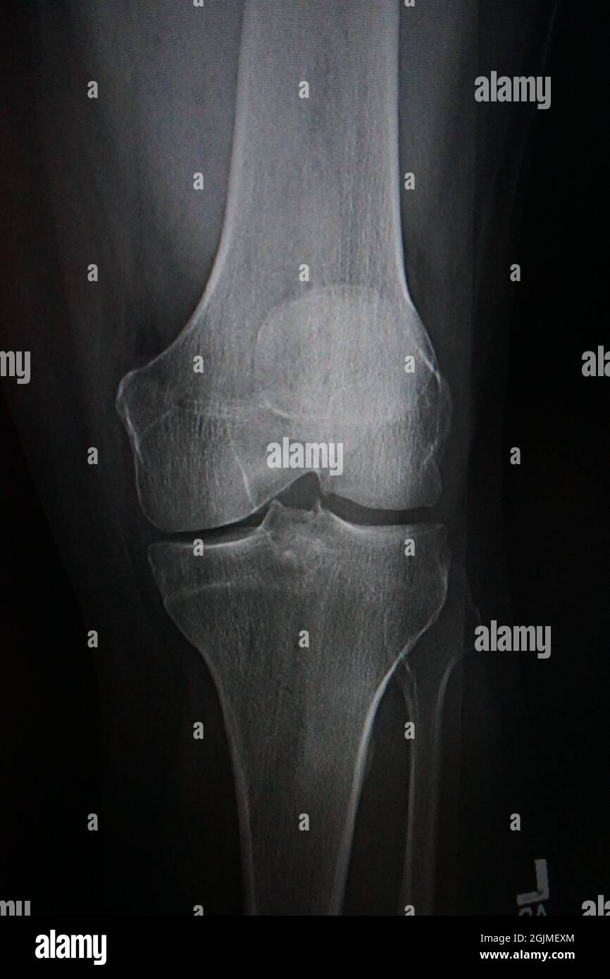 Knee mri hi-res stock photography and images - Alamy