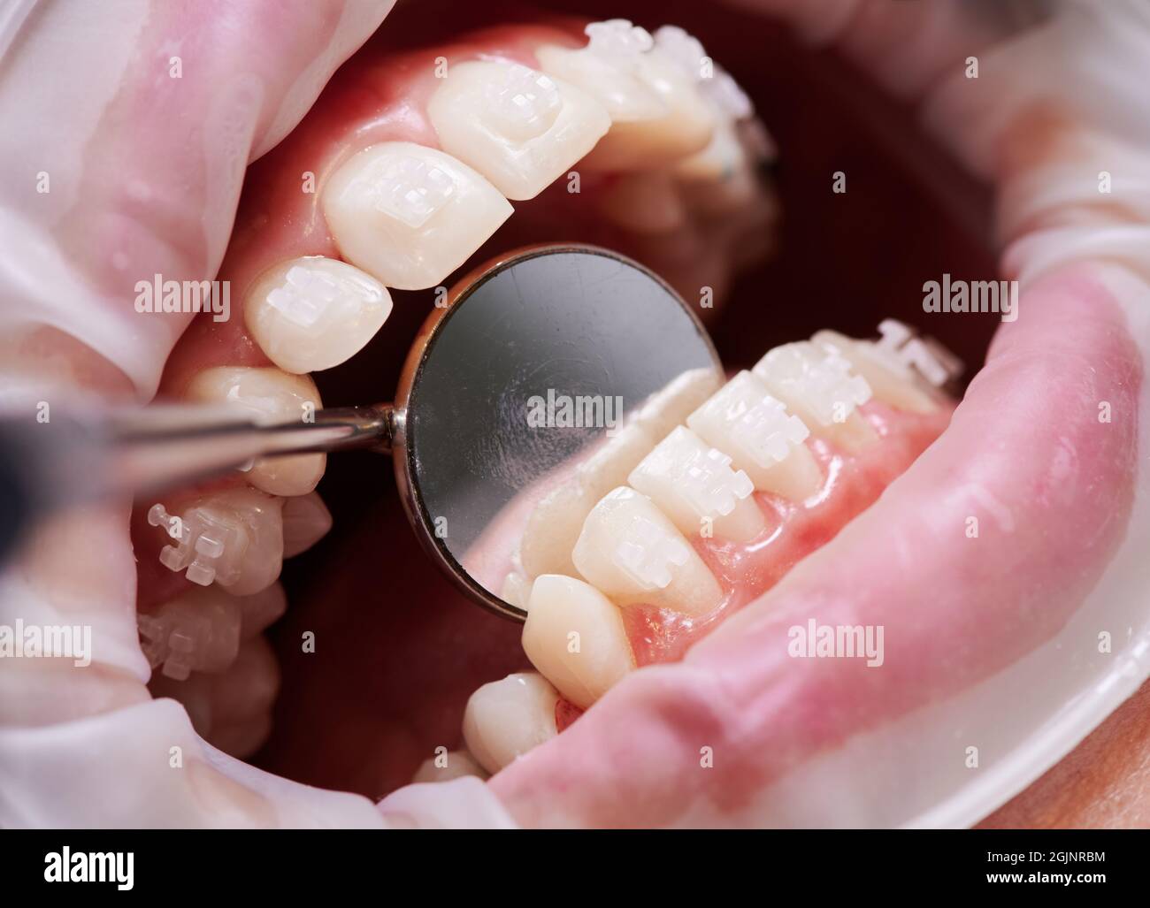Close up of orthodontist checking patient teeth and braces with dental ...