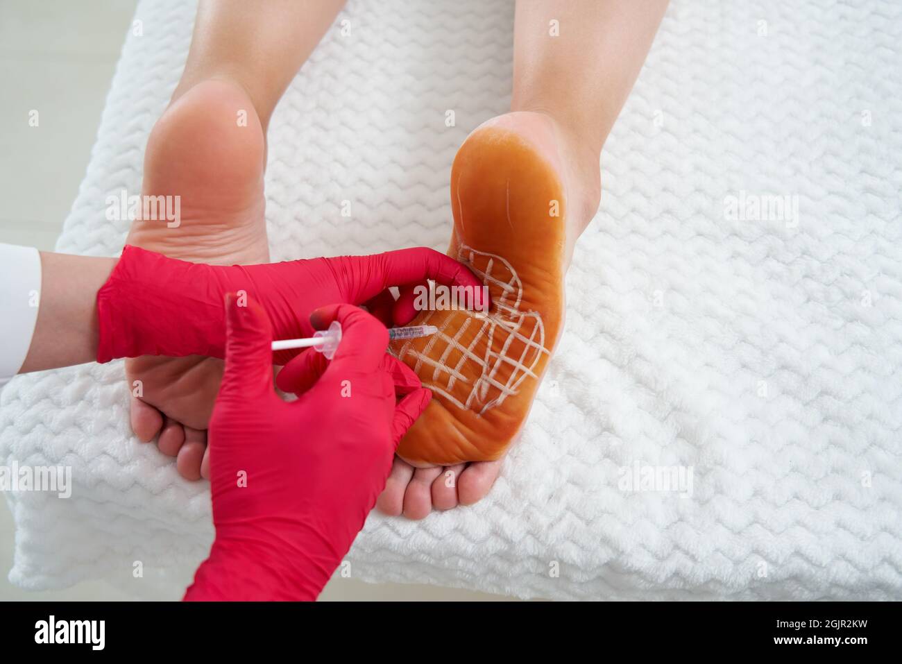 The doctor makes intramuscular injections of botulinum toxinon in ...