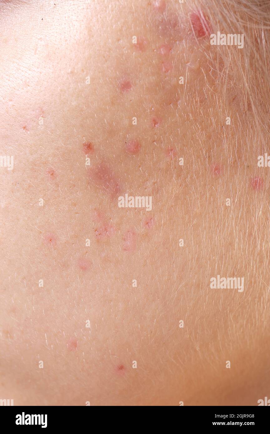 Human skin with acne, closeup Stock Photo - Alamy