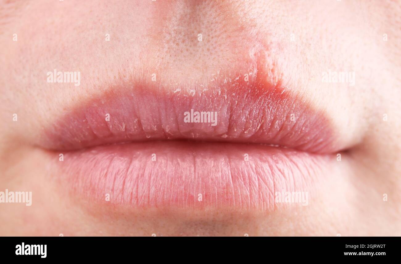 Small Blisters All Over Lips