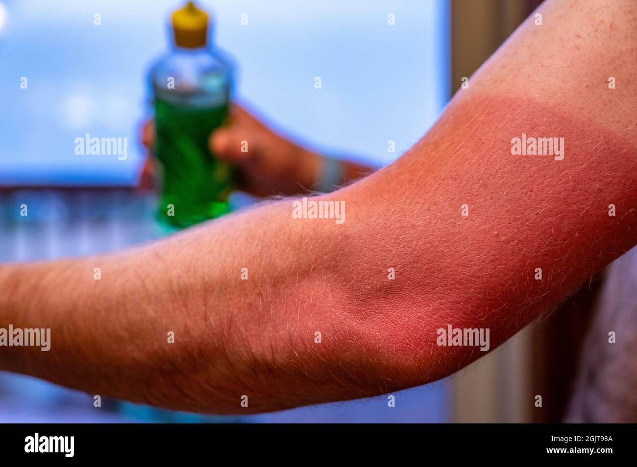 Sunburned arm hi-res stock photography and images - Alamy