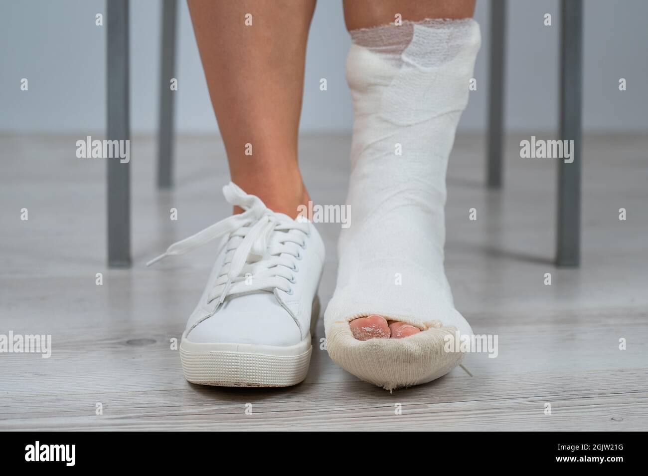 Close-up of female legs with plaster cast. A woman with a broken leg ...