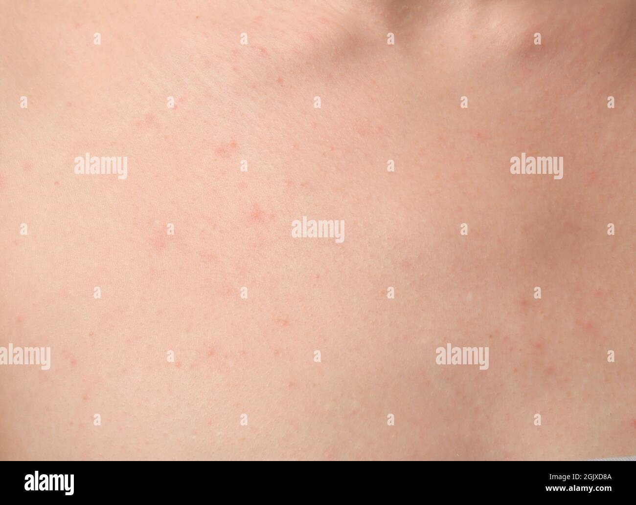 Human skin with pimples, closeup Stock Photo - Alamy
