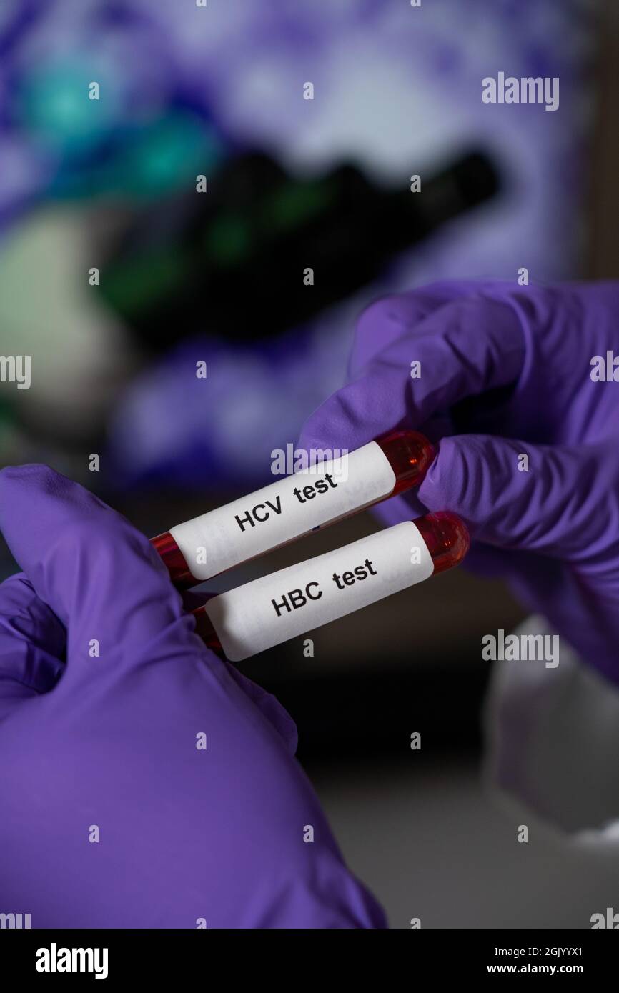 Blood tests for hepatitis B (HBC) and C (HCV Stock Photo - Alamy