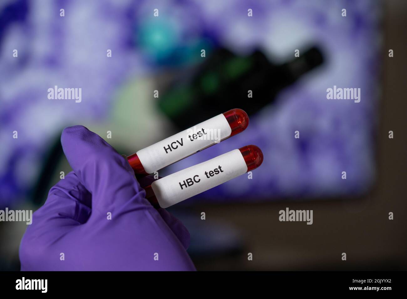 Blood tests for hepatitis B (HBC) and C (HCV Stock Photo - Alamy