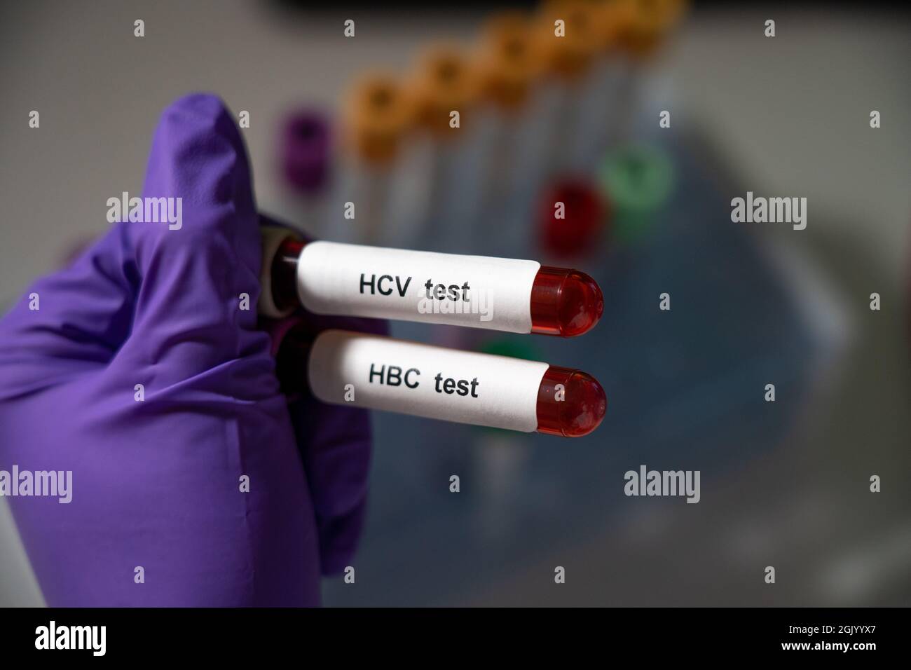 Blood tests for hepatitis B (HBC) and C (HCV Stock Photo - Alamy