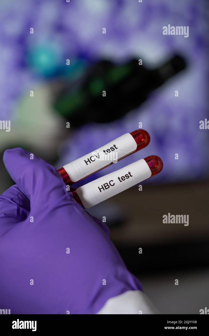 Blood tests for hepatitis B (HBC) and C (HCV Stock Photo - Alamy
