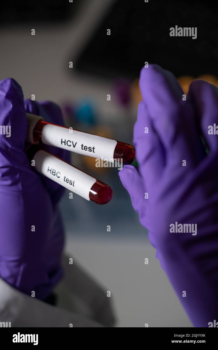 Blood tests for hepatitis B (HBC) and C (HCV Stock Photo - Alamy