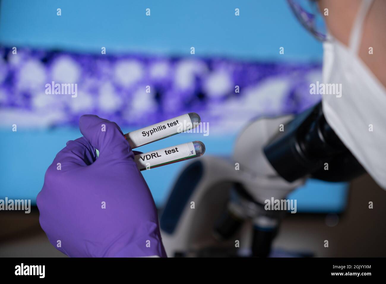 Blood test for syphilis caused by the bacterium treponema pallidum or ...