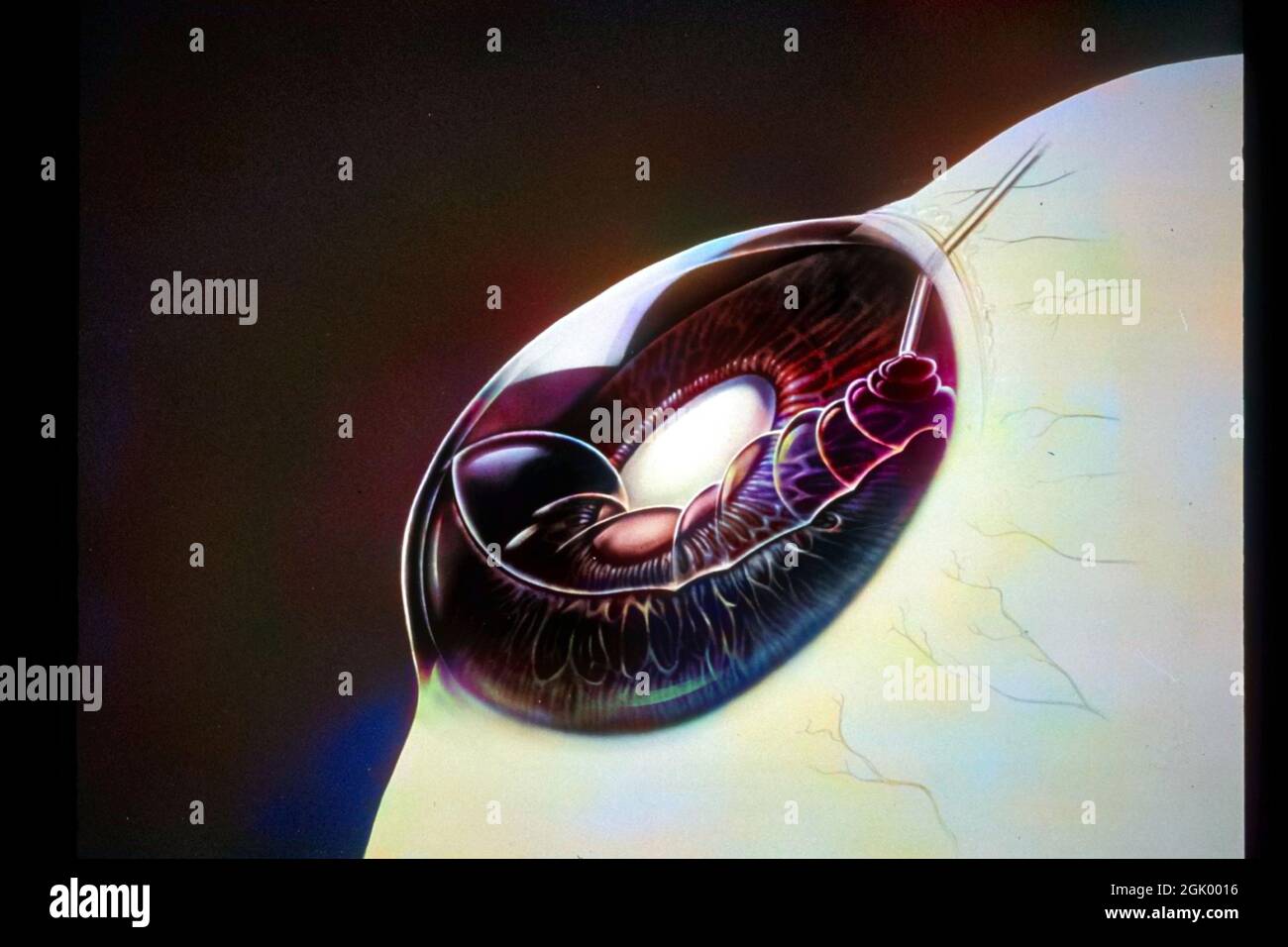 Preparation of the anterior chamber of the eye for corneal implant ...
