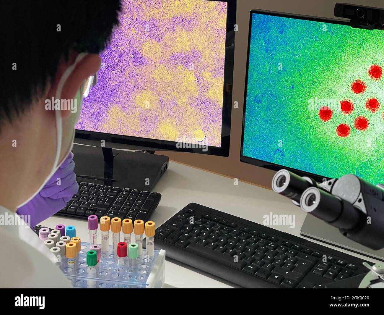Laboratory technician doing research with images of hepatitis A virus ...