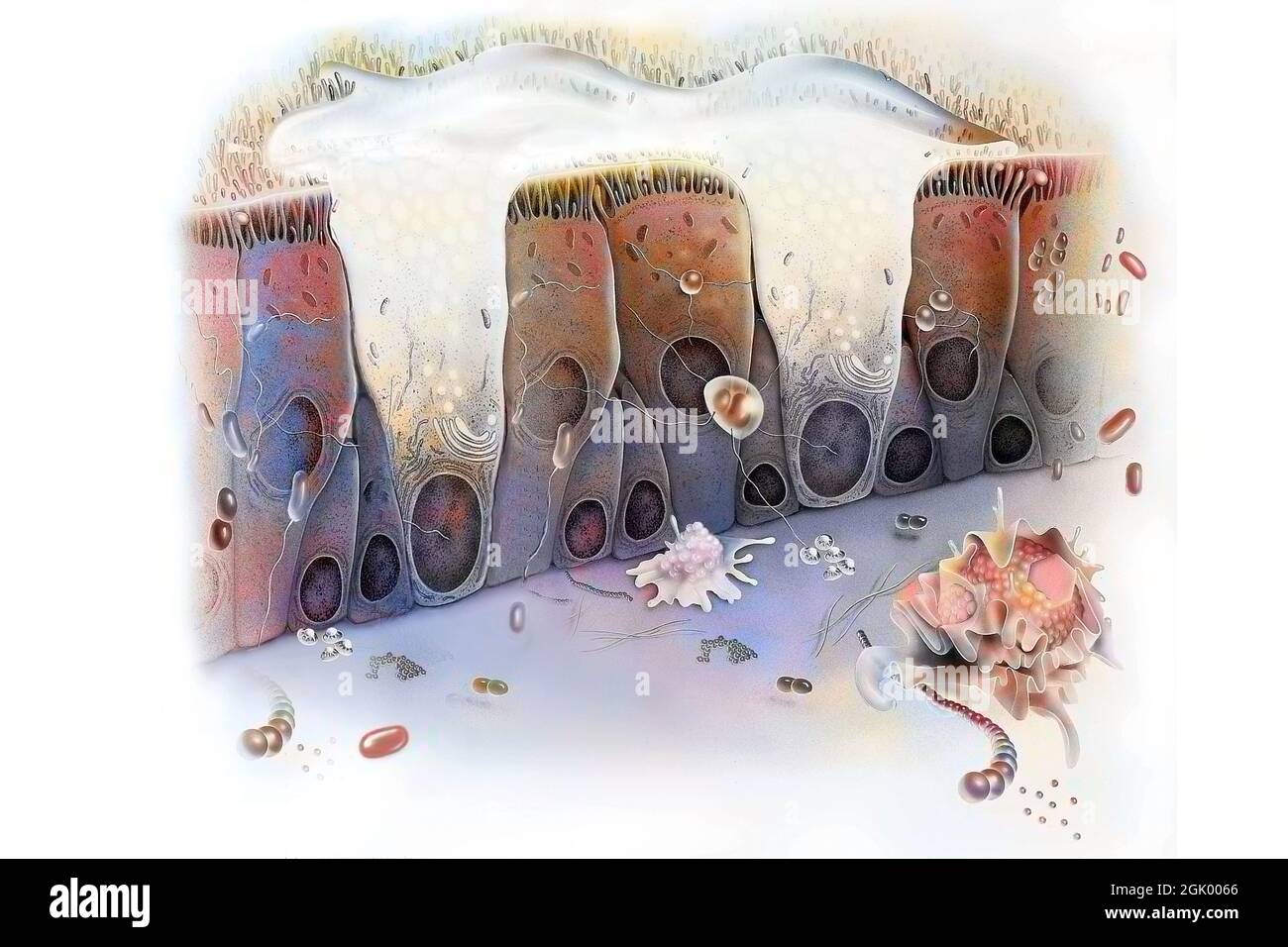 Inflammation of the nasal mucosa: excess mucus and the presence of ...