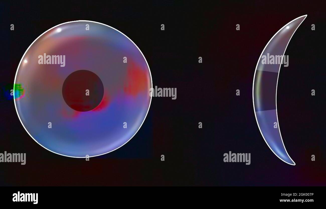 Correction of presbyopia: concentric alternating vision contact lens ...